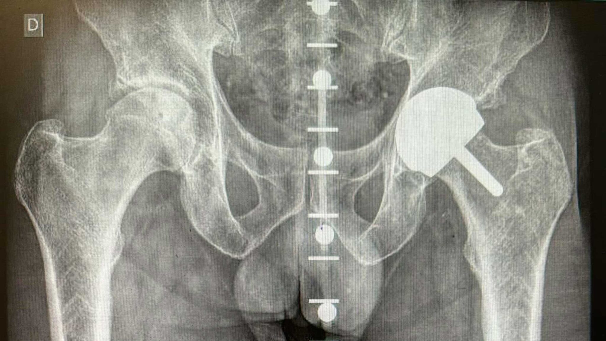 QuirónSalud incorpora un software 3D para la precisa colocación de ...